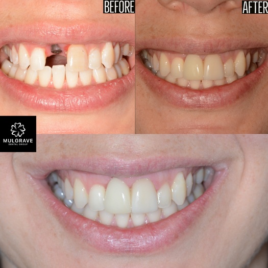 4 Teeth Replacement Options | Mulgrave Dental