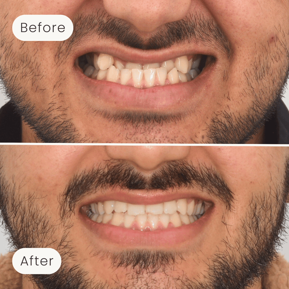 How To Fix Crowded Teeth? | Mulgrave Dental Group